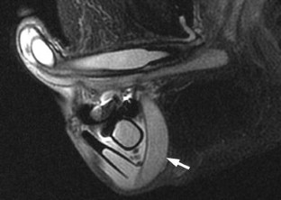 Inflatable penile prosthesis (IPP): diagnosis of complications ...