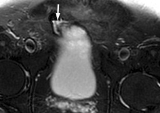 Inflatable penile prosthesis (IPP): diagnosis of complications ...
