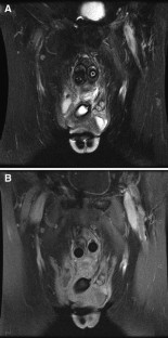 Inflatable penile prosthesis (IPP): diagnosis of complications ...