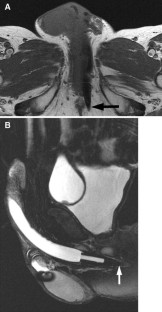 Inflatable penile prosthesis (IPP): diagnosis of complications ...