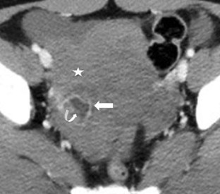 Radiological appearances of corpus luteum cysts and their imaging ...