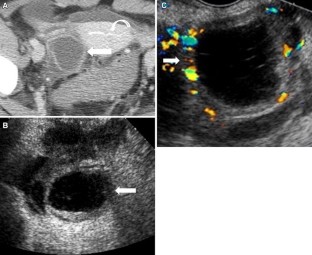 Radiological appearances of corpus luteum cysts and their imaging ...