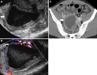 Radiological appearances of corpus luteum cysts and their imaging ...