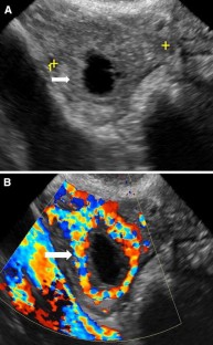 Radiological appearances of corpus luteum cysts and their imaging ...