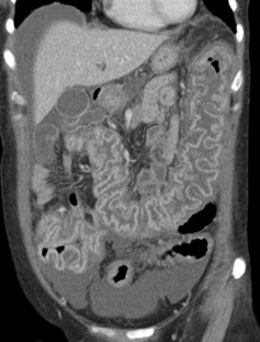 The “accordion sign” | SpringerLink