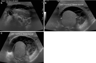 Review of paratesticular pathology: findings on ultrasound and MRI ...