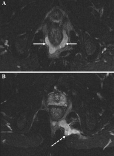 Imaging of acute anorectal conditions with CT and MRI | SpringerLink