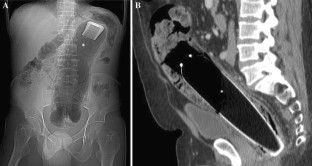 Imaging of acute anorectal conditions with CT and MRI | SpringerLink