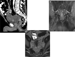 Imaging of acute anorectal conditions with CT and MRI | SpringerLink