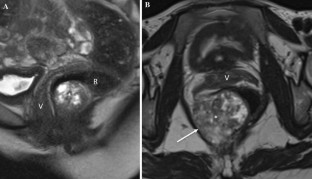 Imaging of acute anorectal conditions with CT and MRI | SpringerLink