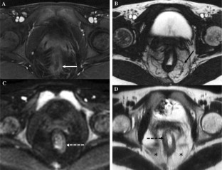 Imaging of acute anorectal conditions with CT and MRI | SpringerLink