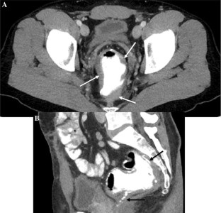 Imaging of acute anorectal conditions with CT and MRI | SpringerLink