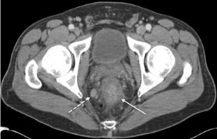 Imaging of acute anorectal conditions with CT and MRI | SpringerLink