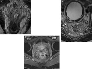 Imaging of acute anorectal conditions with CT and MRI | SpringerLink