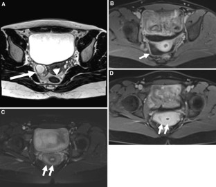 MRI in pelvic inflammatory disease: a pictorial review | SpringerLink
