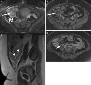 MRI in pelvic inflammatory disease: a pictorial review | SpringerLink
