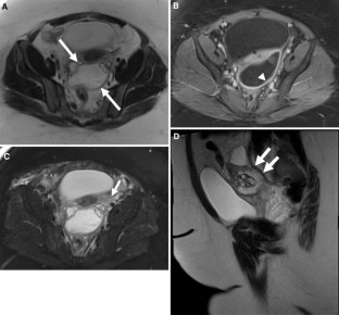 MRI in pelvic inflammatory disease: a pictorial review | SpringerLink