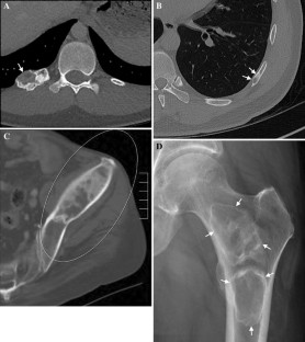 The incidental bone lesion on computed tomography: management tips for ...
