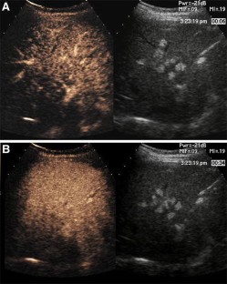Focal fat deposition in the liver: diagnostic challenges on imaging ...
