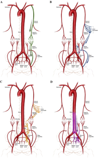 CT angiography and 3D imaging in aortoiliac occlusive disease ...