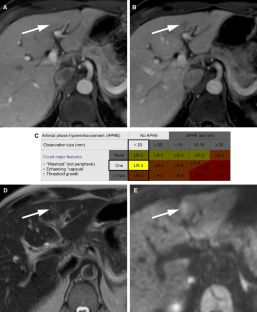 LI-RADS ® algorithm: CT and MRI | SpringerLink