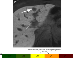 LI-RADS ® algorithm: CT and MRI | SpringerLink