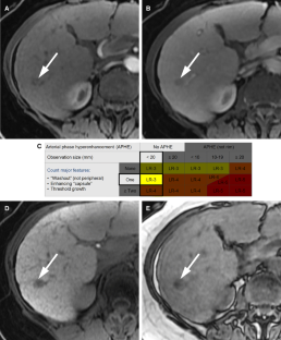LI-RADS ® algorithm: CT and MRI | SpringerLink
