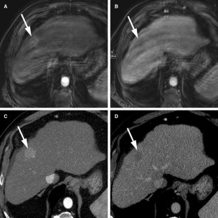 LI-RADS ® algorithm: CT and MRI | SpringerLink