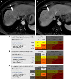 LI-RADS ® algorithm: CT and MRI | SpringerLink