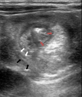The crescent-in-doughnut sign in intussusception | SpringerLink