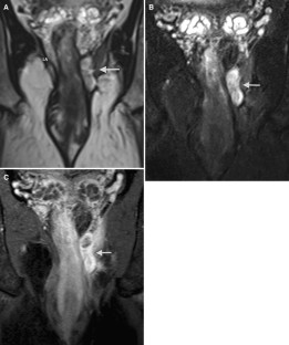 MRI of anal canal: normal anatomy, imaging protocol, and perianal ...