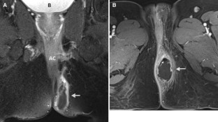 MRI of anal canal: normal anatomy, imaging protocol, and perianal ...