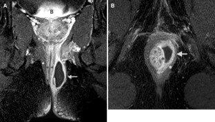 MRI of anal canal: normal anatomy, imaging protocol, and perianal ...