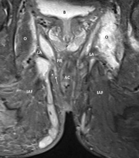 MRI of anal canal: normal anatomy, imaging protocol, and perianal ...