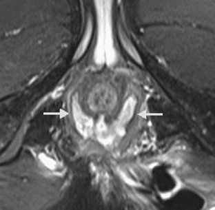 MRI of anal canal: normal anatomy, imaging protocol, and perianal ...
