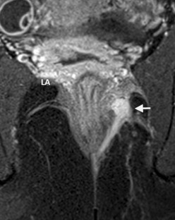 MRI of anal canal: normal anatomy, imaging protocol, and perianal ...