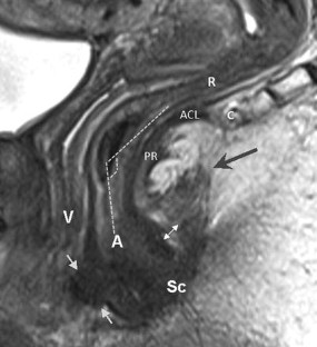 MRI of anal canal: normal anatomy, imaging protocol, and perianal ...