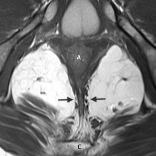 MRI of anal canal: normal anatomy, imaging protocol, and perianal ...