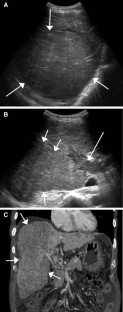 US LI-RADS: ultrasound liver imaging reporting and data system for ...