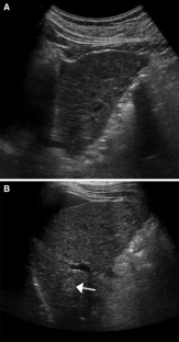 US LI-RADS: ultrasound liver imaging reporting and data system for ...