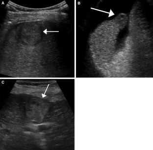 US LI-RADS: ultrasound liver imaging reporting and data system for ...