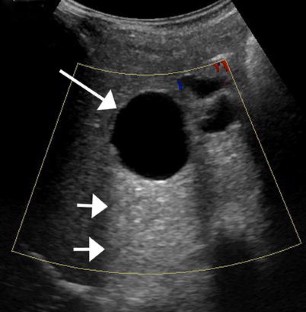 US LI-RADS: ultrasound liver imaging reporting and data system for ...