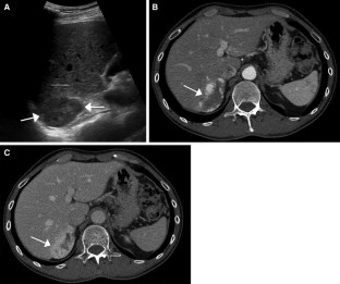 US LI-RADS: ultrasound liver imaging reporting and data system for ...