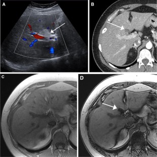 US LI-RADS: ultrasound liver imaging reporting and data system for ...