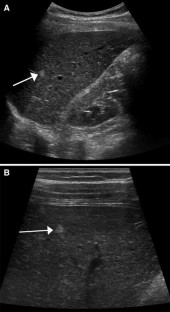 US LI-RADS: ultrasound liver imaging reporting and data system for ...
