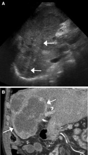 US LI-RADS: ultrasound liver imaging reporting and data system for ...