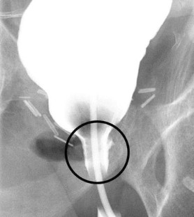 Voiding cystourethrography after prostatectomy: spectrum of appearances ...