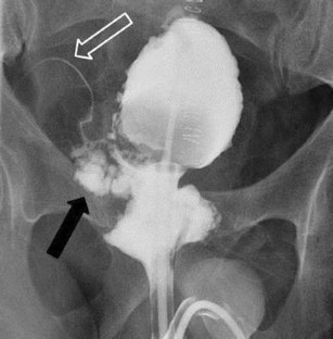 Voiding cystourethrography after prostatectomy: spectrum of appearances ...