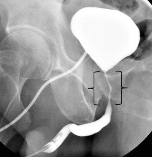 Voiding cystourethrography after prostatectomy: spectrum of appearances ...