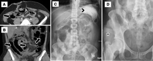 Small bowel obstruction and the gastrografin challenge | Abdominal ...